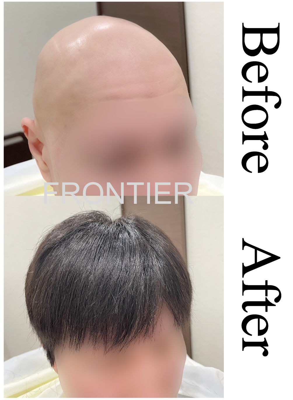 理想のヘアスタイルに | FRONTIER（フロンティア） | 増毛・かつら・ヘアコンタクトなど実績と施術メニュー豊富なサロン